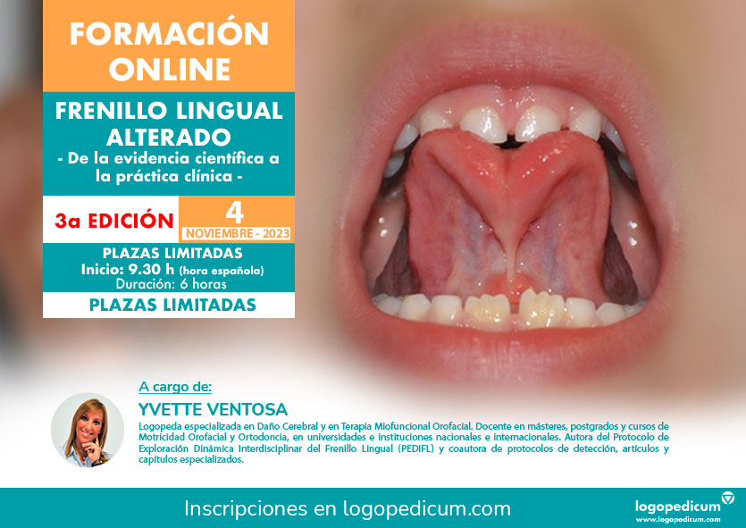 Frenillo lingual alterado - De la evidencia científica a la práctica ...